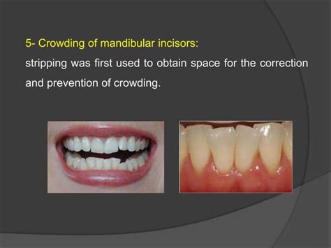 Interproximal Enamel Reduction Stripping Pptx Dental Health