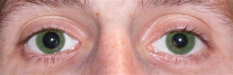Can Aneurysm Cause One Pupil To Be More Dilated Than The Other Scary Symptoms