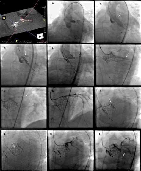 Computed Tomography Ct And Fluoroscopy Images A Ct Depicting Low Download Scientific