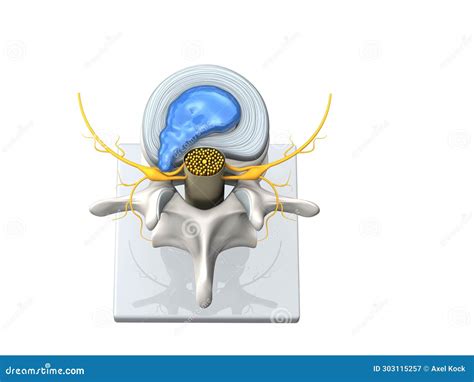 Model Of A Herniated Disc Of The Lumbar Spine Stenosis Slipped Disc
