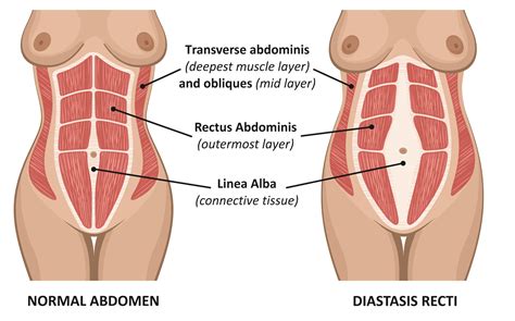 Condition Womens Health And Mens Health Rectus Diastasis And Abdominal