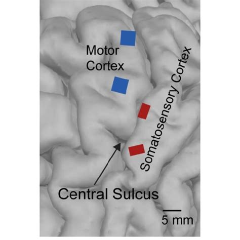 Location Of Implanted Electrode Arrays Marked On A Pre Surgical
