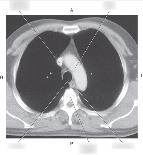 Axial Aortic Arch Diagram Quizlet