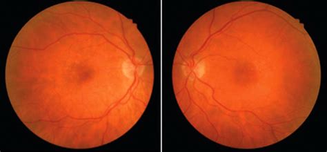 Study Identifies Potential Markers Of Amd Progression From Early To