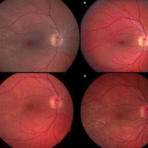 The Development Of Lesions In Multifocal Pattern Dystrophy A Download Scientific Diagram