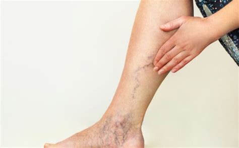 Varizes Pélvicas Como Identificar E Lidar Com Esta Condição