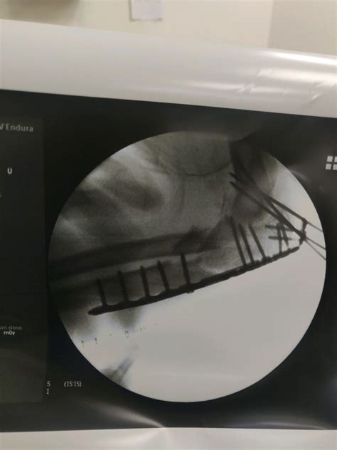 Ehab Maher On Linkedin Fixation Of Comminuted Fracture Of Olecranon With Elbow Dislocation