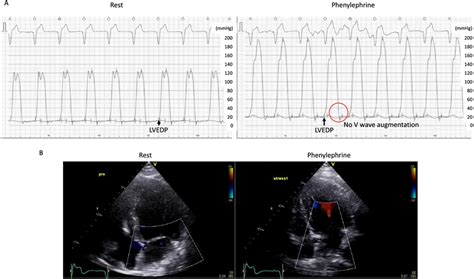 Waveform Recording Of The Intra‐left Ventricular Pressure And The Pcwp Download Scientific Waveform Recording Of The Intra‐left Ventricular Pressure And The Pcwp Download Scientific