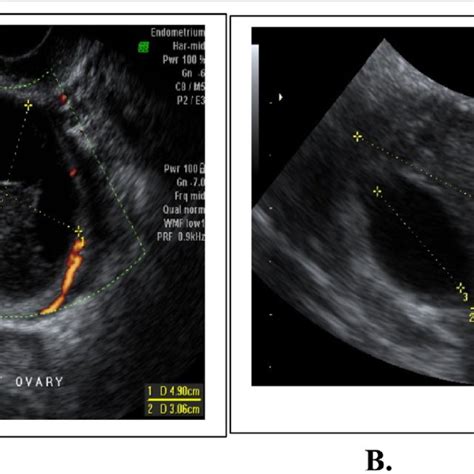 Mayo Endoscopic Subscore Descriptors And Representative Images Mayo 0 A