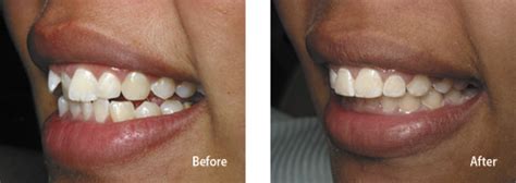 6 Month Braces Matthew Healey Dmd Billerica Ma