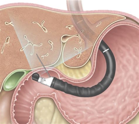 Endoscopy And Liver Disease At Clinton Spears Blog