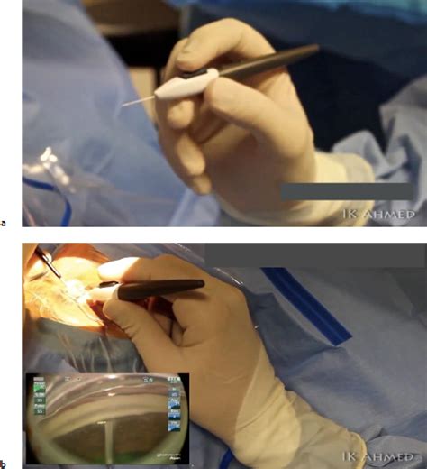 Microinvasive Glaucoma Surgery Ento Key