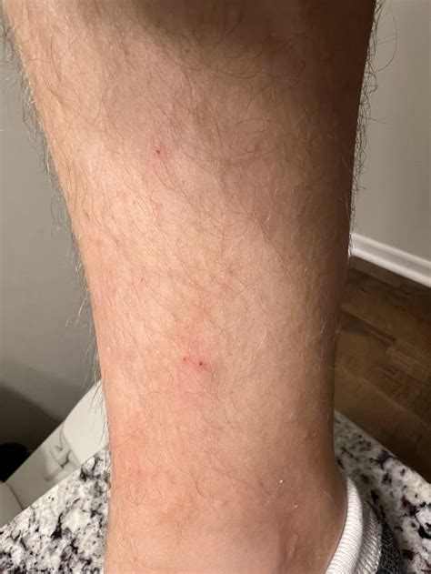 Does This Look Like A Bed Bug Or Scabies Bite Rbugbites