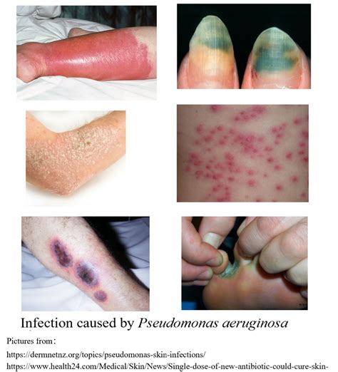 Pseudomonas Aeruginosa Skin Infection