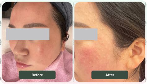 Rejuran Healer Before And After Photos Proven Results