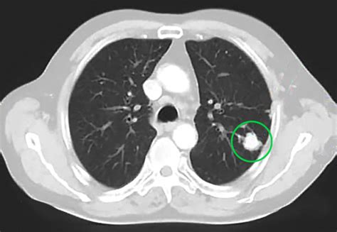 Bronchoscopic Pulsed Electric Field Pef Ablation For Lung Tumors