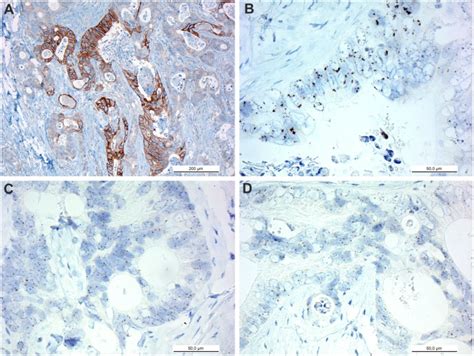 Egfr Ihc Shows Heterogeneous Staining With Intensive Membranous