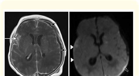 Axial A Post Contrast T1w Mri Brain Showing A Subdural Collection