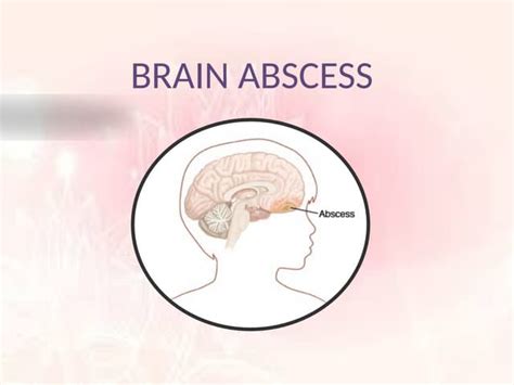 Brain Abscess Pptx Dsgswgewgwhtrgtwgrgrdt Ppt