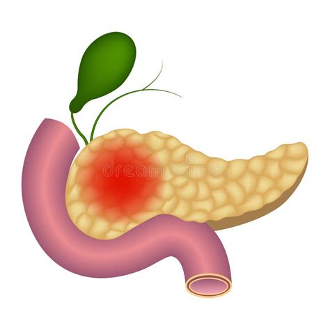 Inflammation Of The Human Pancreas Stock Vector Illustration Of Cholesterol Pancreatitis
