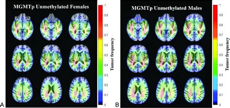 Sex Specific Differences In Patients With Idh1wild Type Grade 4 Glioma