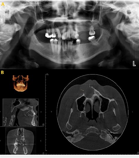 Figure 1 From The Utility Of Cone Beam Computed Tomography Scans In