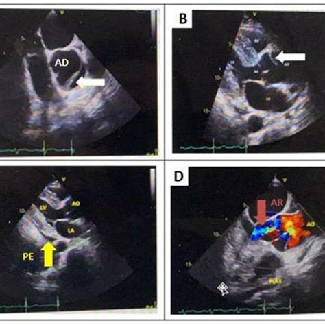 A D Echocardiographic Views Revealed A Suspicion Of A Flap At The Download Scientific Diagram