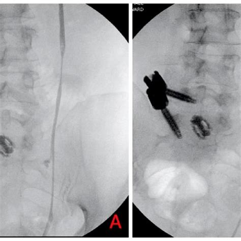 A Repeat Cystoscopy Left Retrograde Pyelogram With Persistent Distal