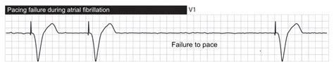 Assessment Of Pacemaker Malfunction The Cardiovascular