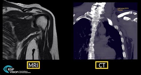 Rsip Vision Announces New Tool For Total Shoulder Arthroplasty Planning Through Mri Scan