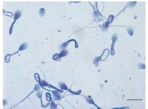 Diff Quick Stained Smear Showing A High Proportion Of Defective