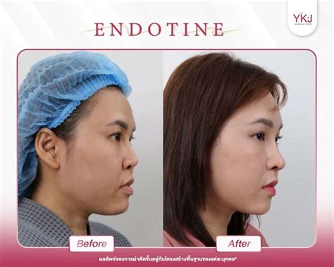 รีวิวภาพก่อนหลังโปรแกรมดึงหน้า กระชับใบหน้า Ykj Medical Clinic