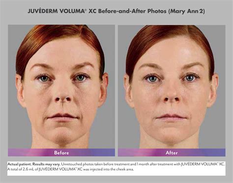 Juvederm Voluma Xc Before And After Photos Wamwhm