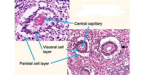 Yolk Sac Tumor Schiller Duval Bodies