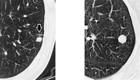 Figure 2 From Intrapulmonary Lymph Nodes Thin Section Ct Findings
