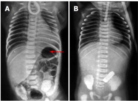 12 Congenital Anomalies Of Gi Tract Flashcards Quizlet