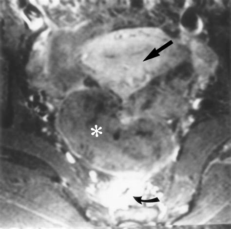 What Is Enlarged Leiomyomatous Uterus At Jeffrey Worsham Blog