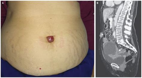 Bleeding Umbilical Nodule In A 73 Year Old Diagnosis Medizzy Journal