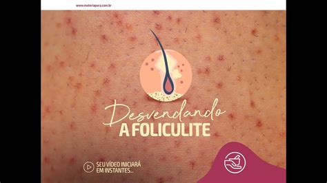 Tudo O Que Você Precisa Saber Sobre Foliculite Youtube