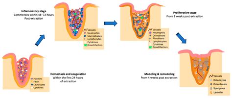 Tooth Extraction Socket Bone Healing At Mark Cox Blog