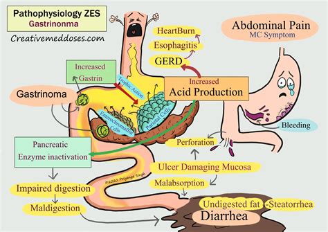 Zollinger Ellison Syndrome Cancer Jrye
