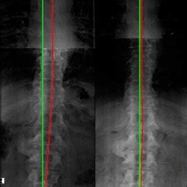 Castellvi Classification Of Transitional Lumbosacral Vertebra Tlv