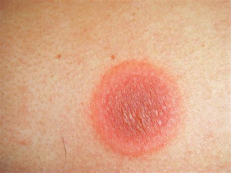 Sopp I Underlivet Menn