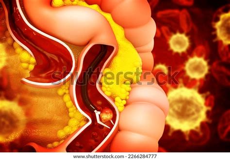Colon Cancer Colonoscopy Colon Polyp Removal Stock Illustration 2266284777 Shutterstock