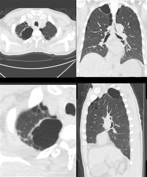 000 Bleb The Common Vein
