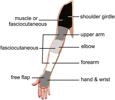 An Overview Algorithm For Perforator Free Flap Coverage Of All Zones Of