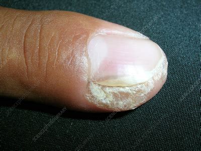 Periungual Warts Stock Image C0561047 Science Photo Library