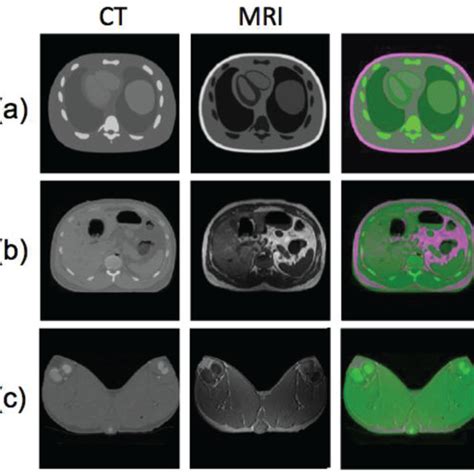 Pdf Simultaneous Ct Mri Reconstruction For Constrained Imaging Geometries Using Structural
