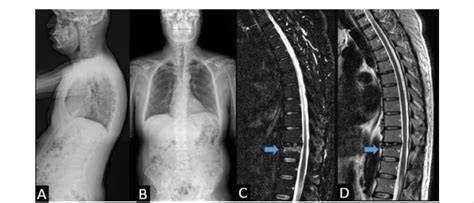 Thoracic 11 Vertebra Type A1 Fracture According To The Ao Spine