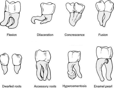 Dentistry And Medicine Developmental Anomalies Of Tooth Diagram